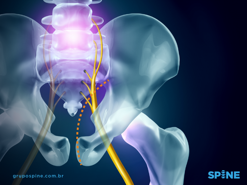 Grupo Spine | Ciatalgia