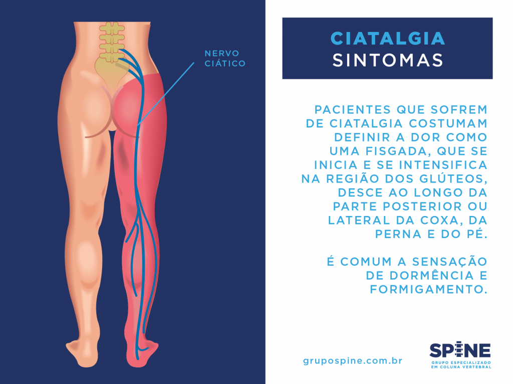 Grupo Spine | Ciatalgia